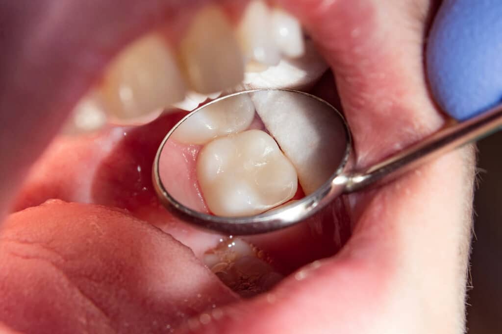 The Best Biocompatible Fillings for Holistic Dental Care